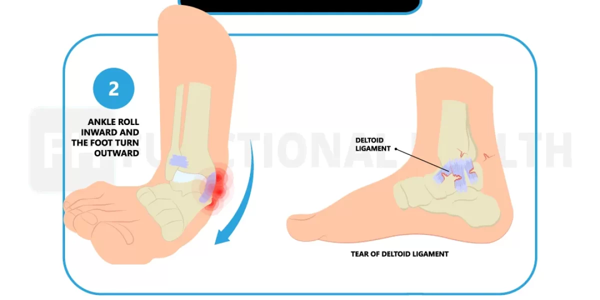 Eversion Ankle Sprain - Functional Health Physiotherapy Gold Coast ...